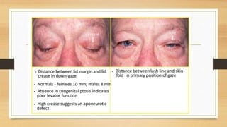 Approach for ptosis | PPTX