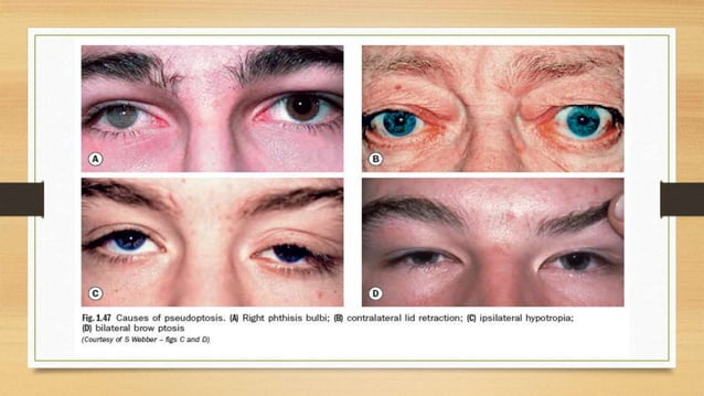 Approach for ptosis | PPTX | Eye and Vision Conditions | Diseases and ...