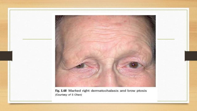 Approach for ptosis | PPTX | Eye and Vision Conditions | Diseases and ...