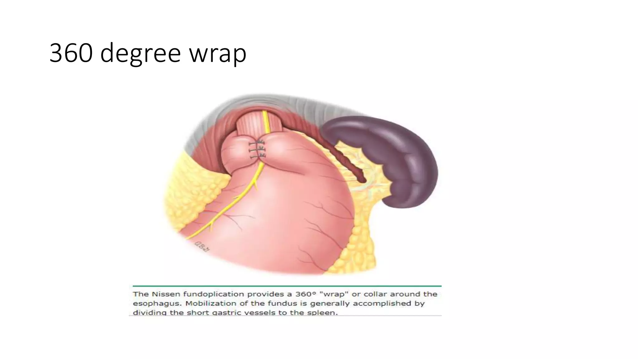 Approach, indications and surgical management of gerd 2 | PPTX