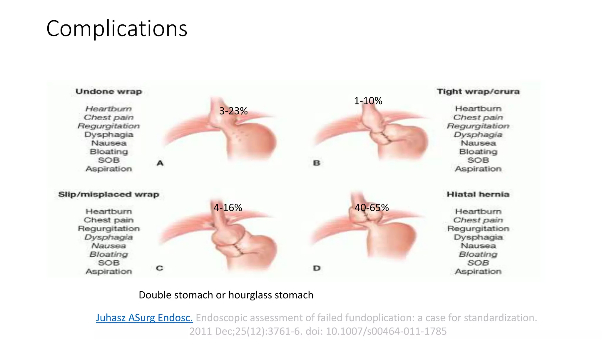 Approach, indications and surgical management of gerd 2 | PPTX