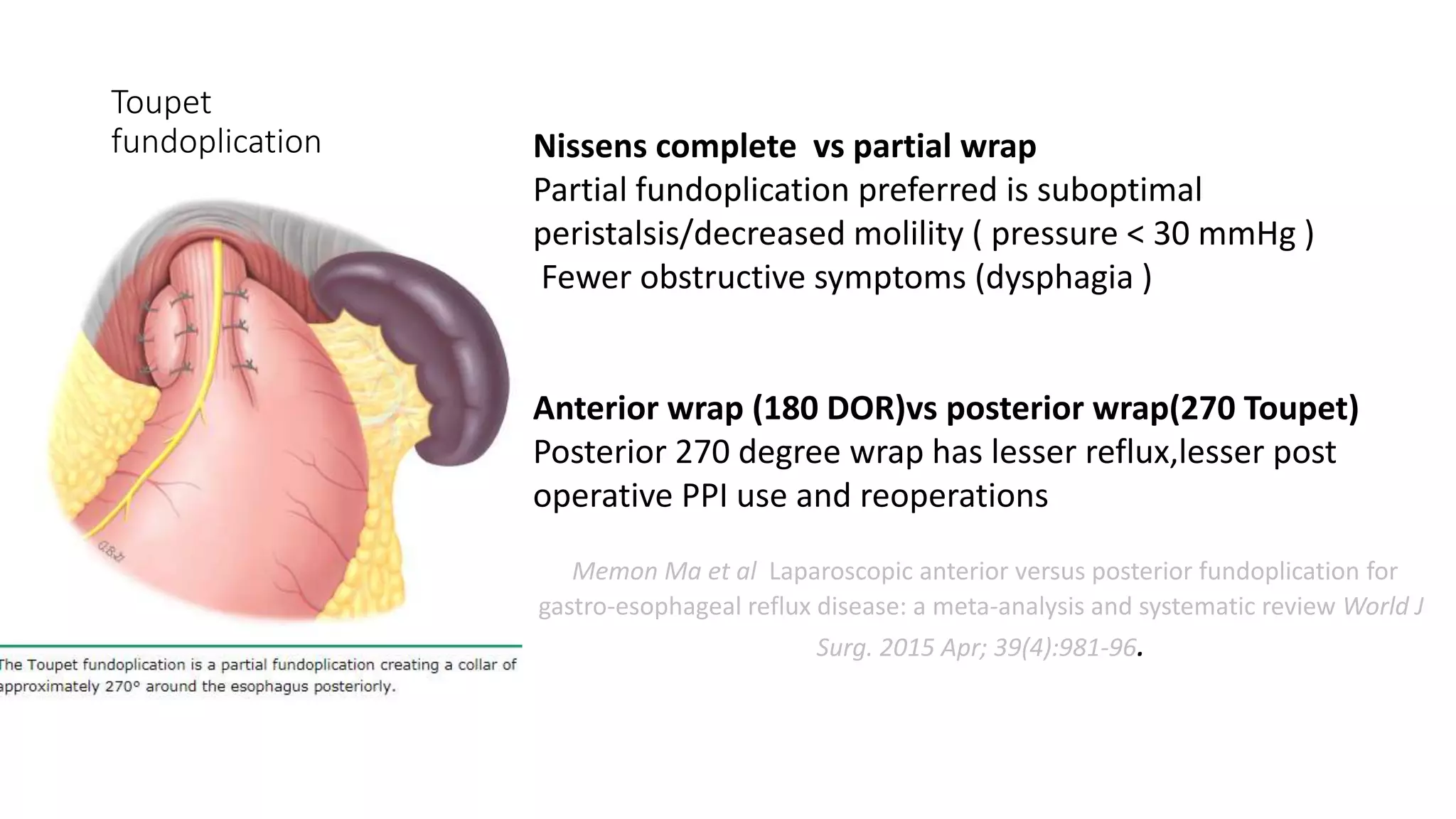 Approach, indications and surgical management of gerd 2 | PPTX