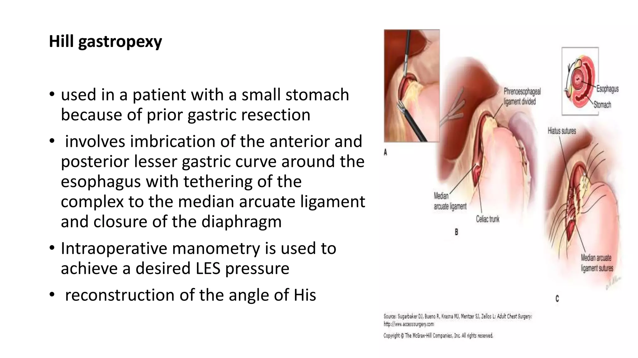 Approach, indications and surgical management of gerd 2 | PPTX