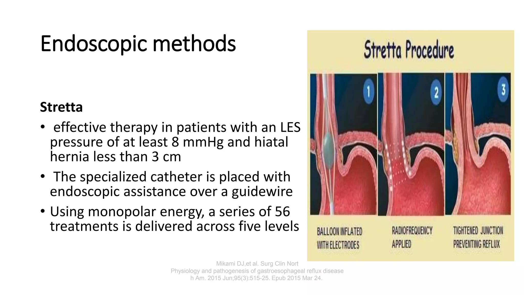 Approach, indications and surgical management of gerd 2 | PPTX