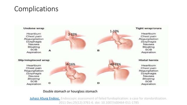 Approach, indications and surgical management of gerd 2 | PPTX