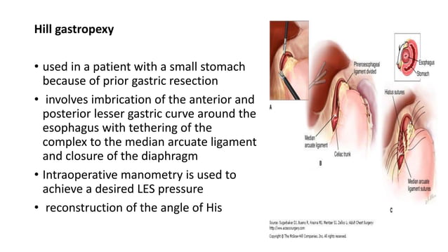 Approach, indications and surgical management of gerd 2 | PPTX