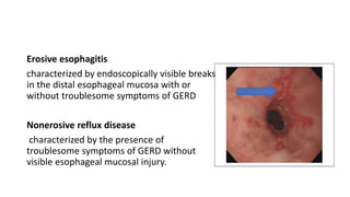 Approach, indications and surgical management of gerd 2 | PPTX