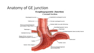 management of gastro-esophageal reflux disease | PPTX