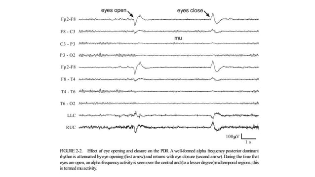 Approaching the eeg | PPTX | Brain and Nervous System Disorders ...