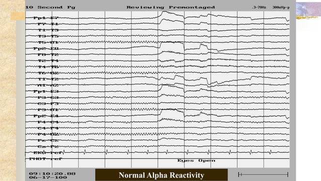 Approaching the eeg | PPTX | Brain and Nervous System Disorders ...