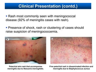 APPROACH OF MENINGITIS (1).pptx