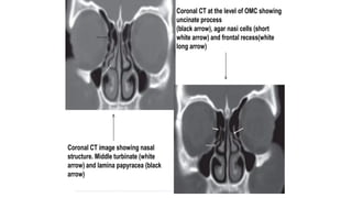 Approach of paranasal sinuses radiology .pptx