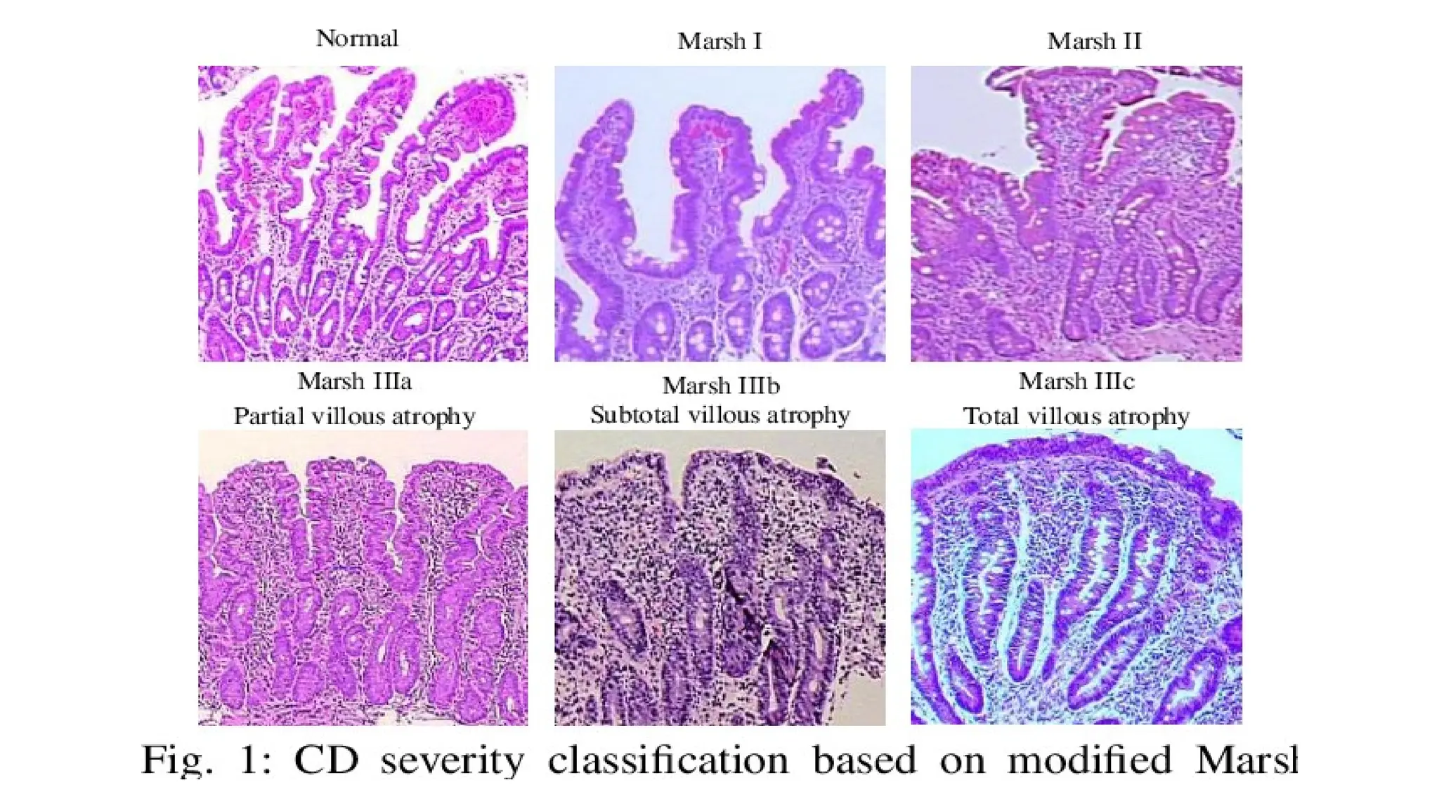 approach o malabsorption presentation in pediatrics | PPTX