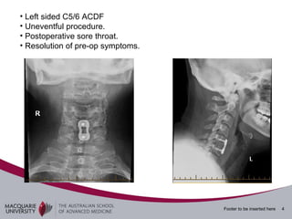 Approach side during anterior cervical discectomy | PPT