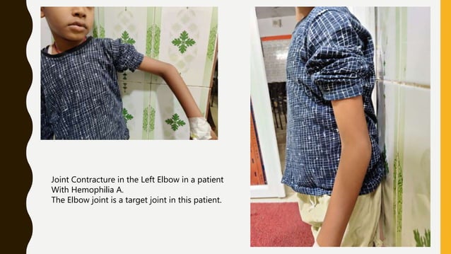 Approach To A Bleeding Child | PPTX | Blood Disorders | Diseases and ...