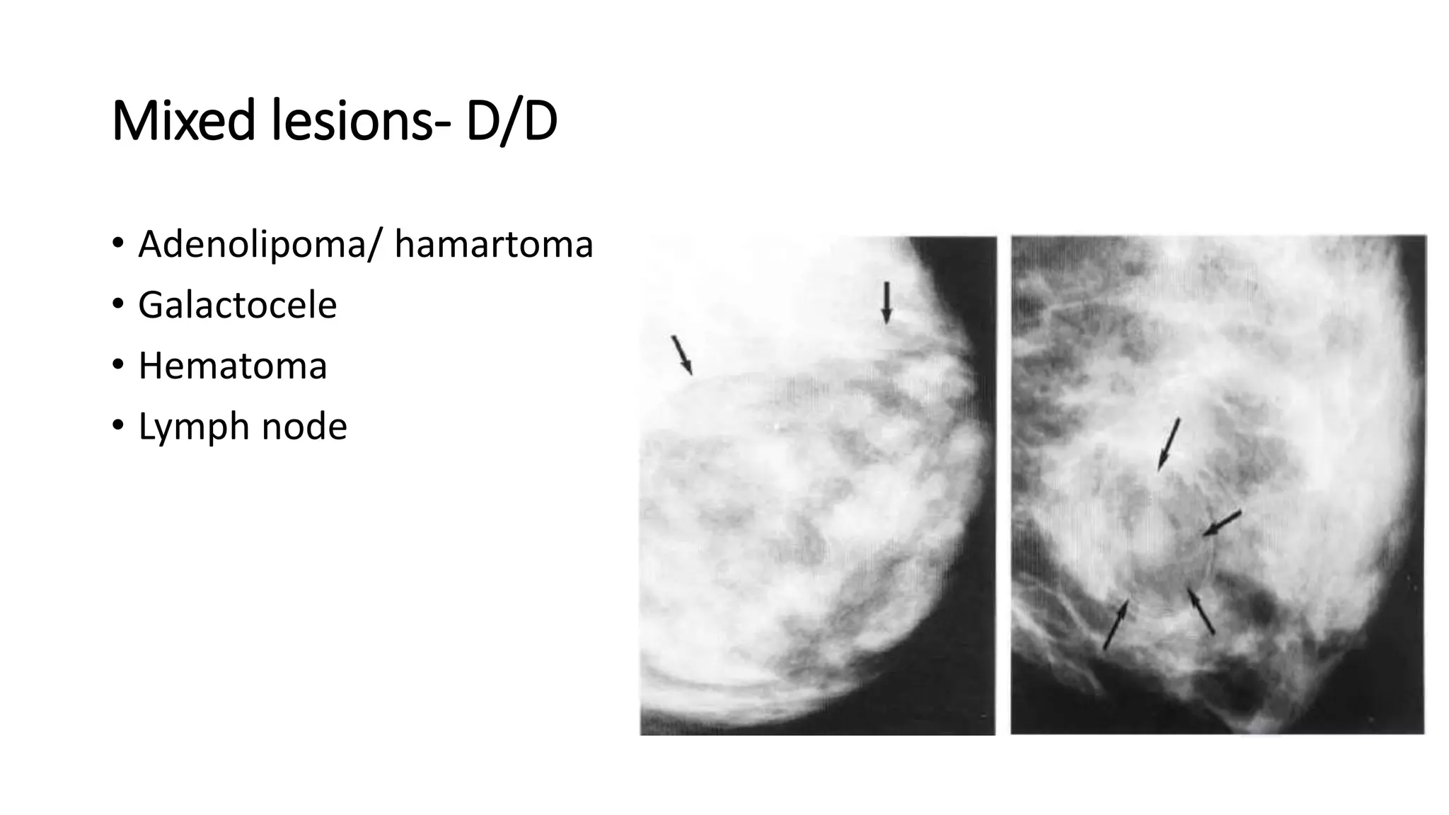 APPROACH TO A BREAST LESION- MAMMOGRAPHY AND ULTRASONOGRAPHY.pptx