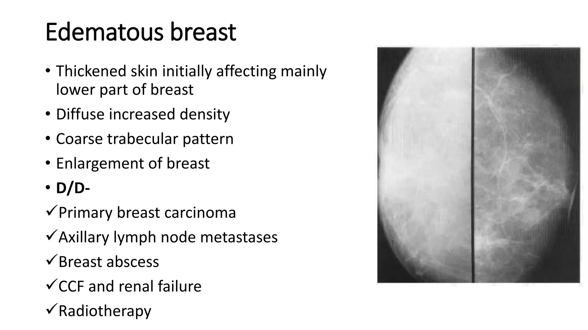 APPROACH TO A BREAST LESION- MAMMOGRAPHY AND ULTRASONOGRAPHY.pptx