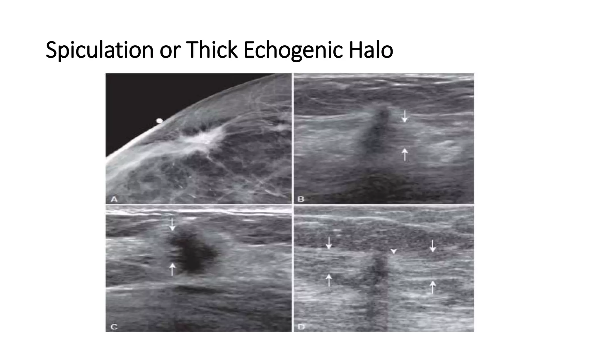 APPROACH TO A BREAST LESION- MAMMOGRAPHY AND ULTRASONOGRAPHY.pptx