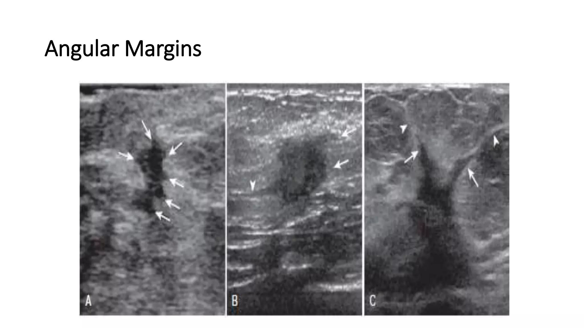 APPROACH TO A BREAST LESION- MAMMOGRAPHY AND ULTRASONOGRAPHY.pptx