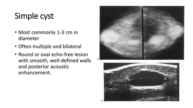 APPROACH TO A BREAST LESION- MAMMOGRAPHY AND ULTRASONOGRAPHY.pptx