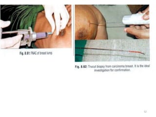 Approach to a breast lump (hari sedai; MMC, IOM) | PPTX