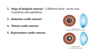 Approach to a case of adult cataract.pptx