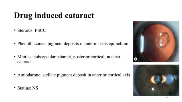 Approach to a case of adult cataract.pptx | Eye and Vision Conditions ...