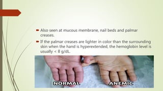 Approach to a case of anemia | PPTX