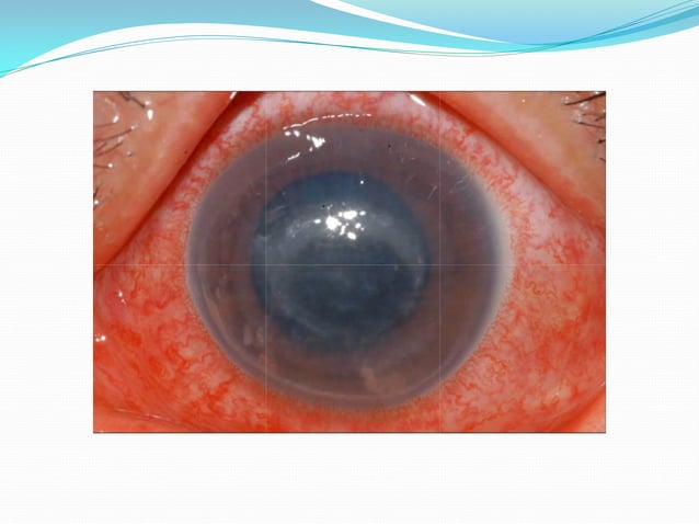 Approach to a case of corneal ulcer | PDF