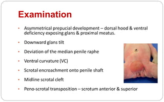 Approach to a case of Hypospadias.pptx