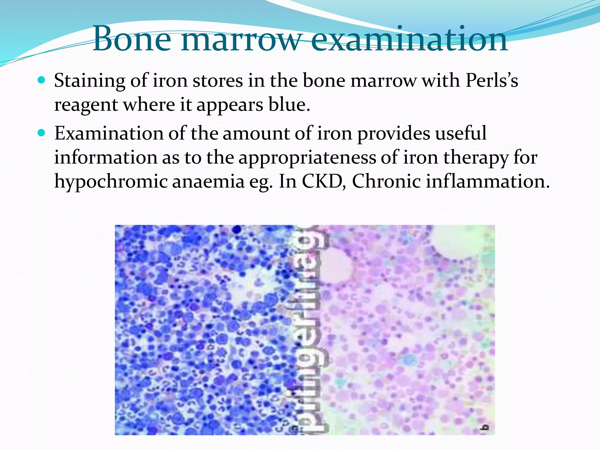 Approach to a case of iron defciency anaemia | PPTX