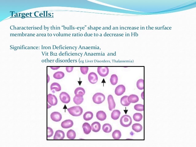 Approach to a case of iron defciency anaemia