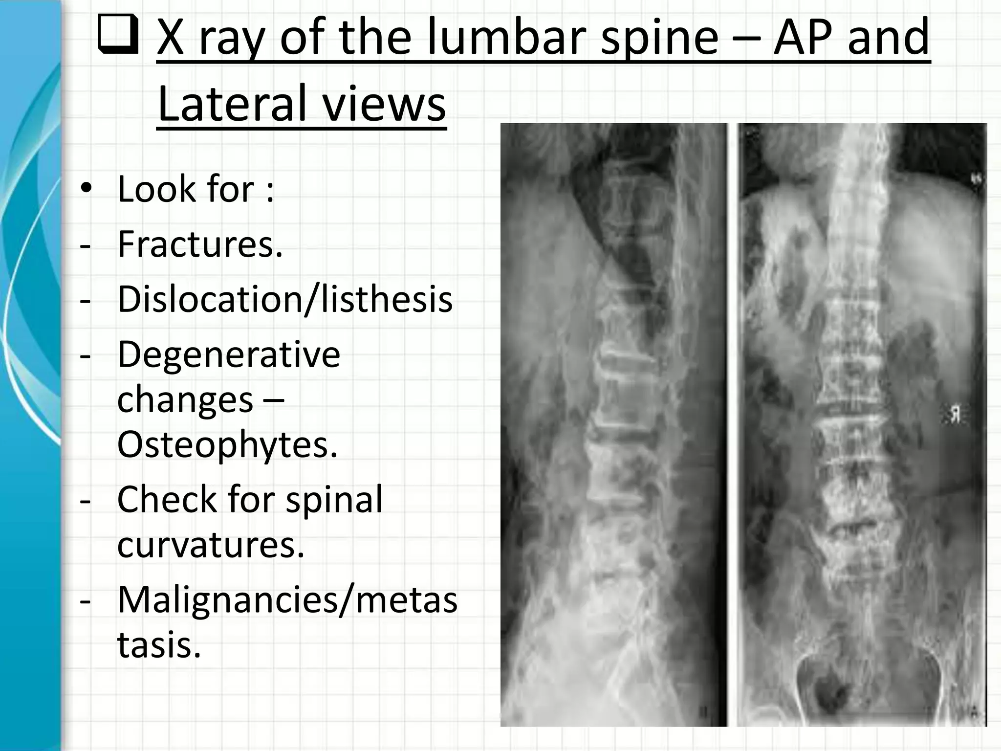 Approach to a case of lumbar intervertebral disc | PPTX
