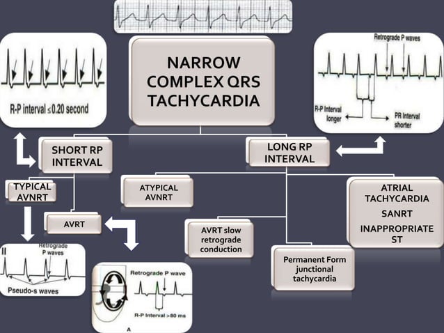 Approach to a case of narrow complex tachycardia | PPTX