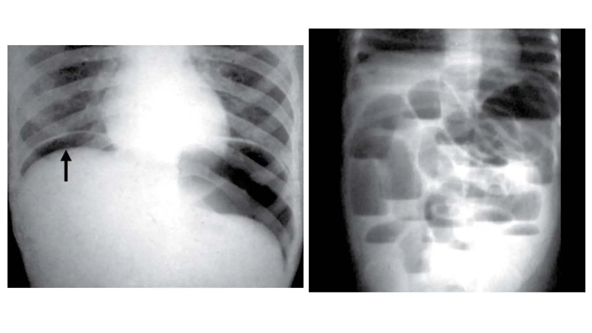 APPROACH TO A PATIENT WITH PERITONITIS.pptx