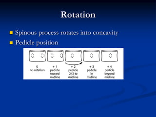 APPROACH_TO_A_CASE_OF_SCOLIOSIS.ppt