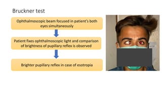 Approach to accommodative esotropia | PPTX