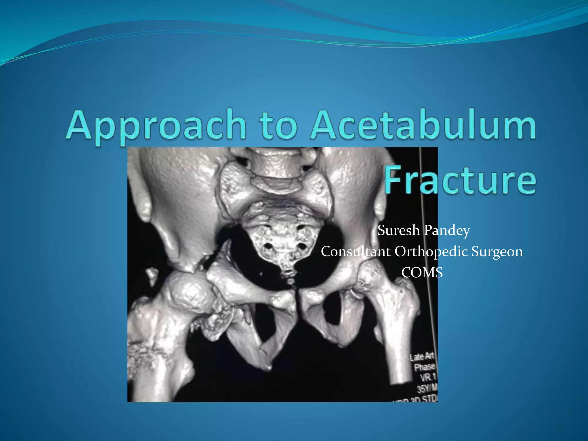 Approach to acetabulum fracture zoom 2020 | PPT