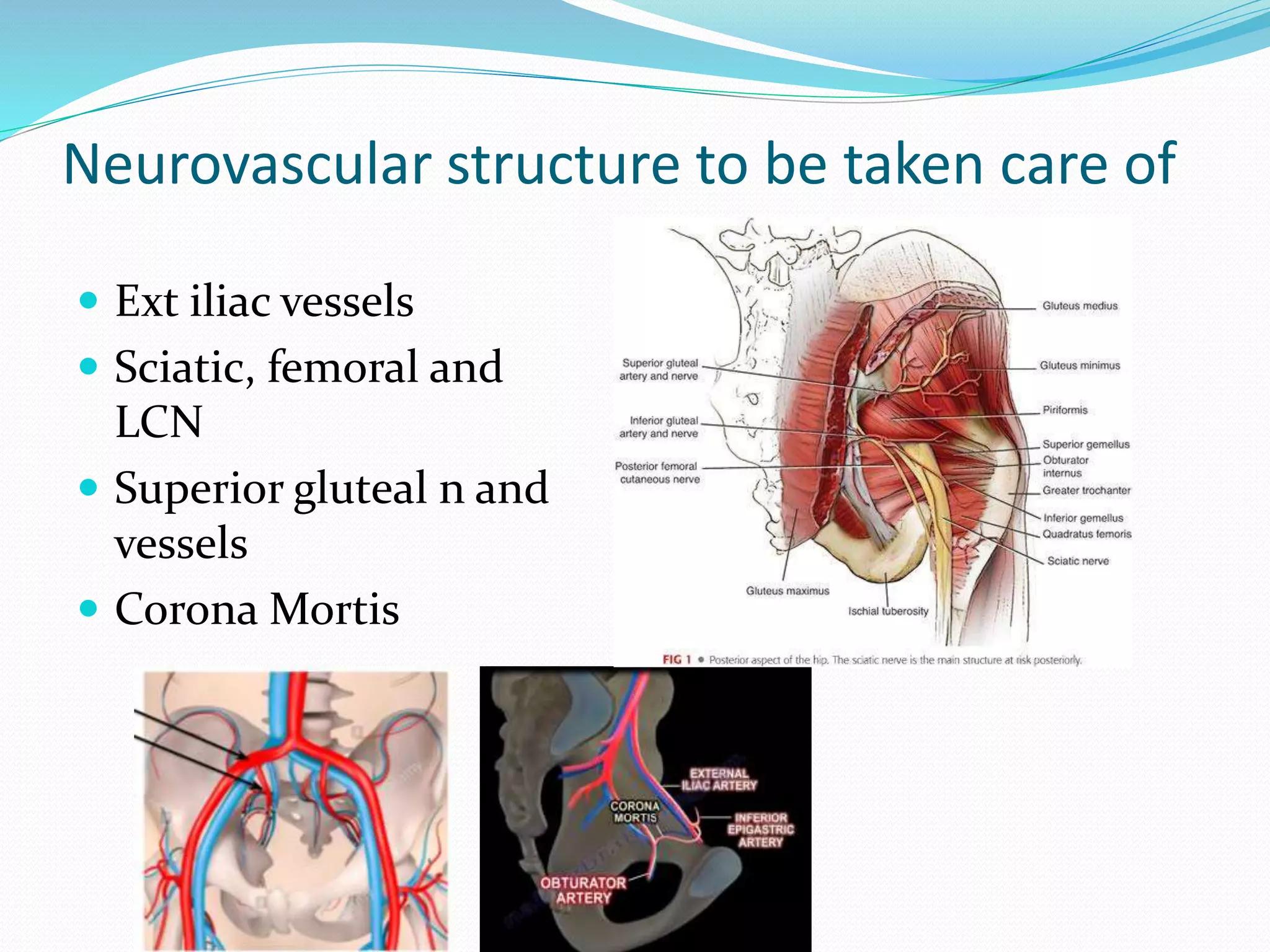 Approach to acetabulum fracture zoom 2020 | PPTX