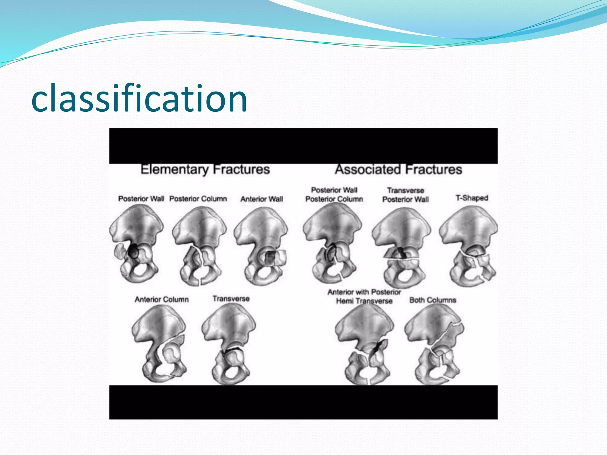 Approach to acetabulum fracture zoom 2020 | PPT
