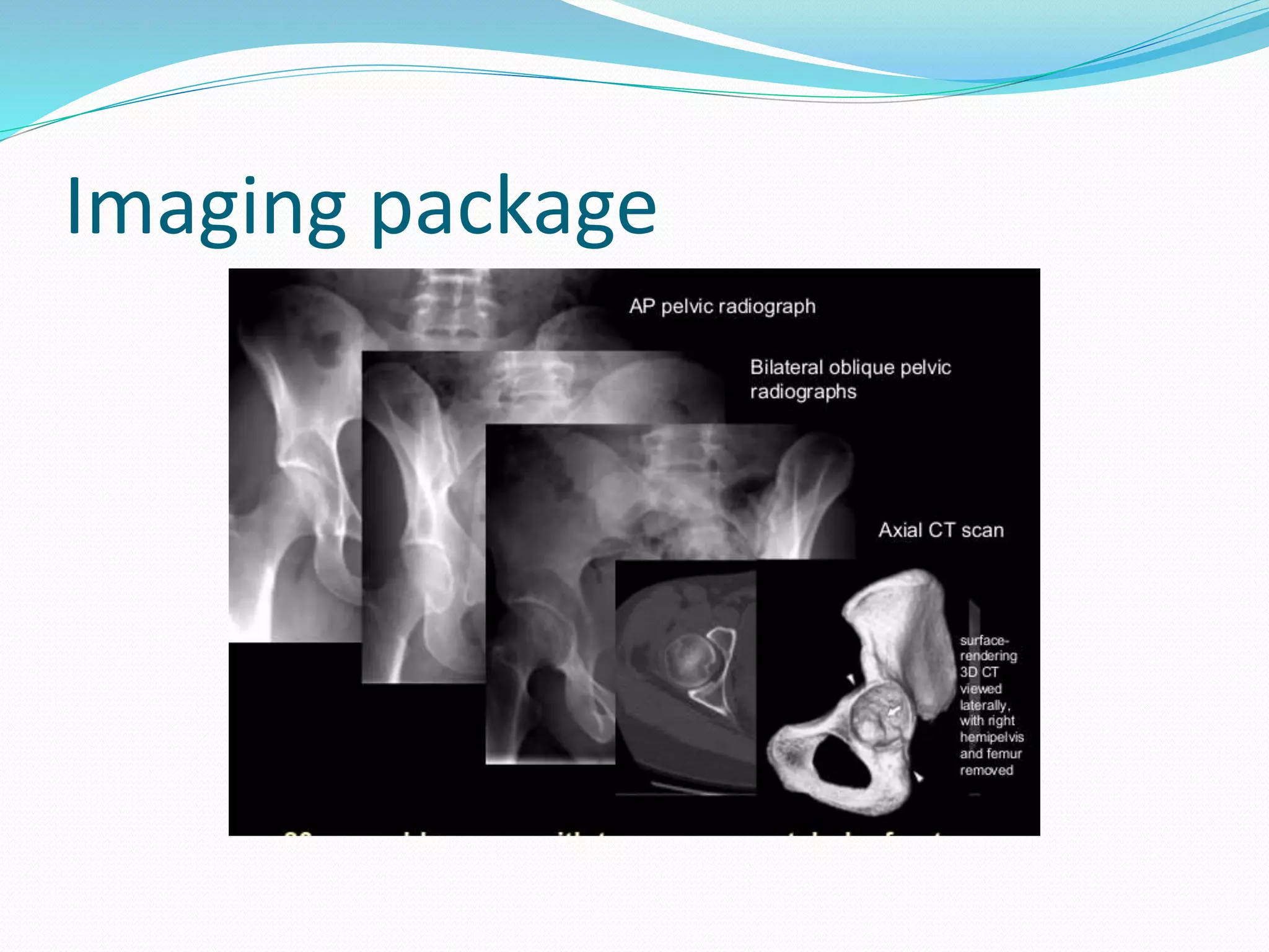 Approach to acetabulum fracture zoom 2020 | PPTX