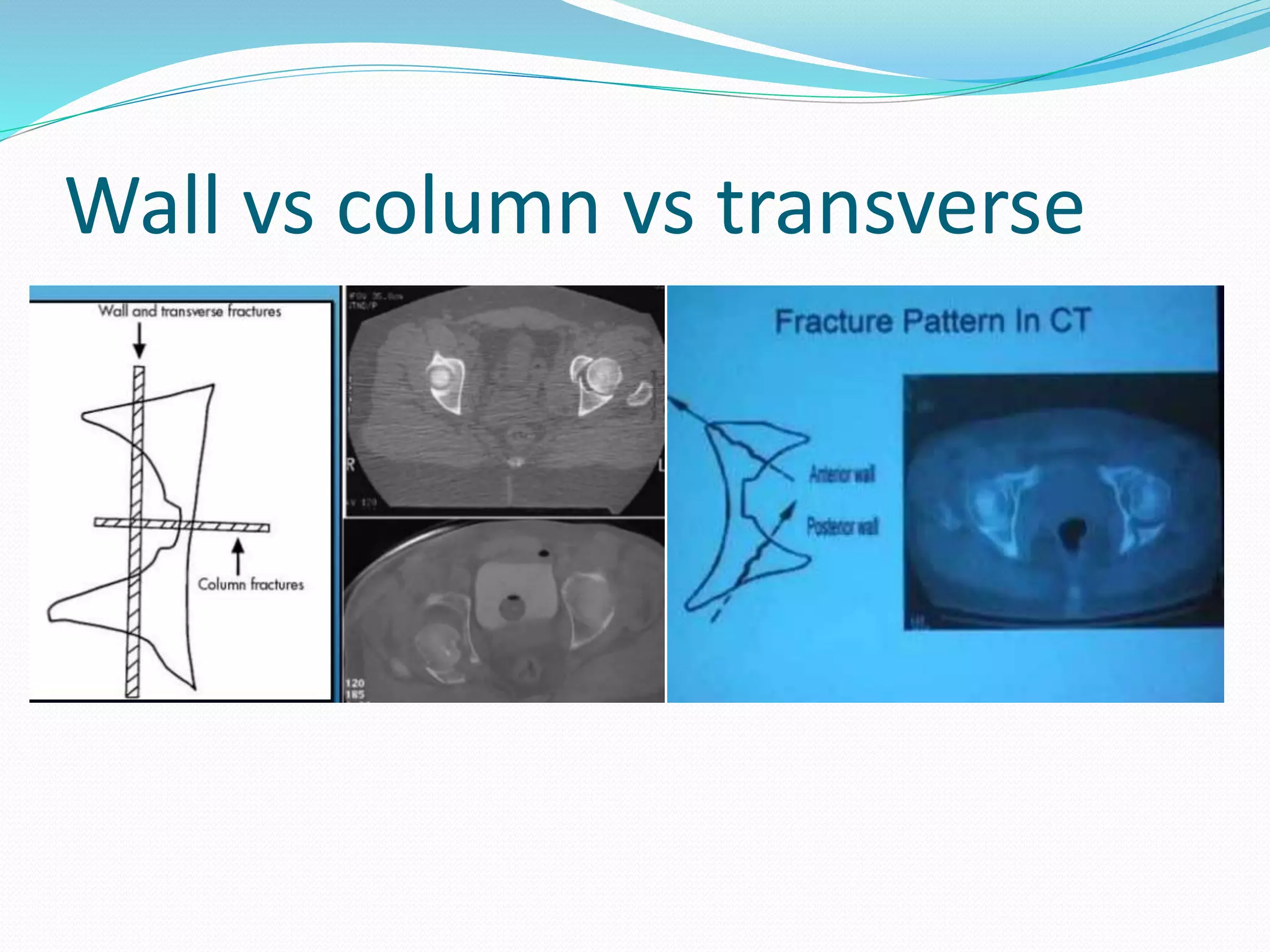 Approach to acetabulum fracture zoom 2020 | PPTX