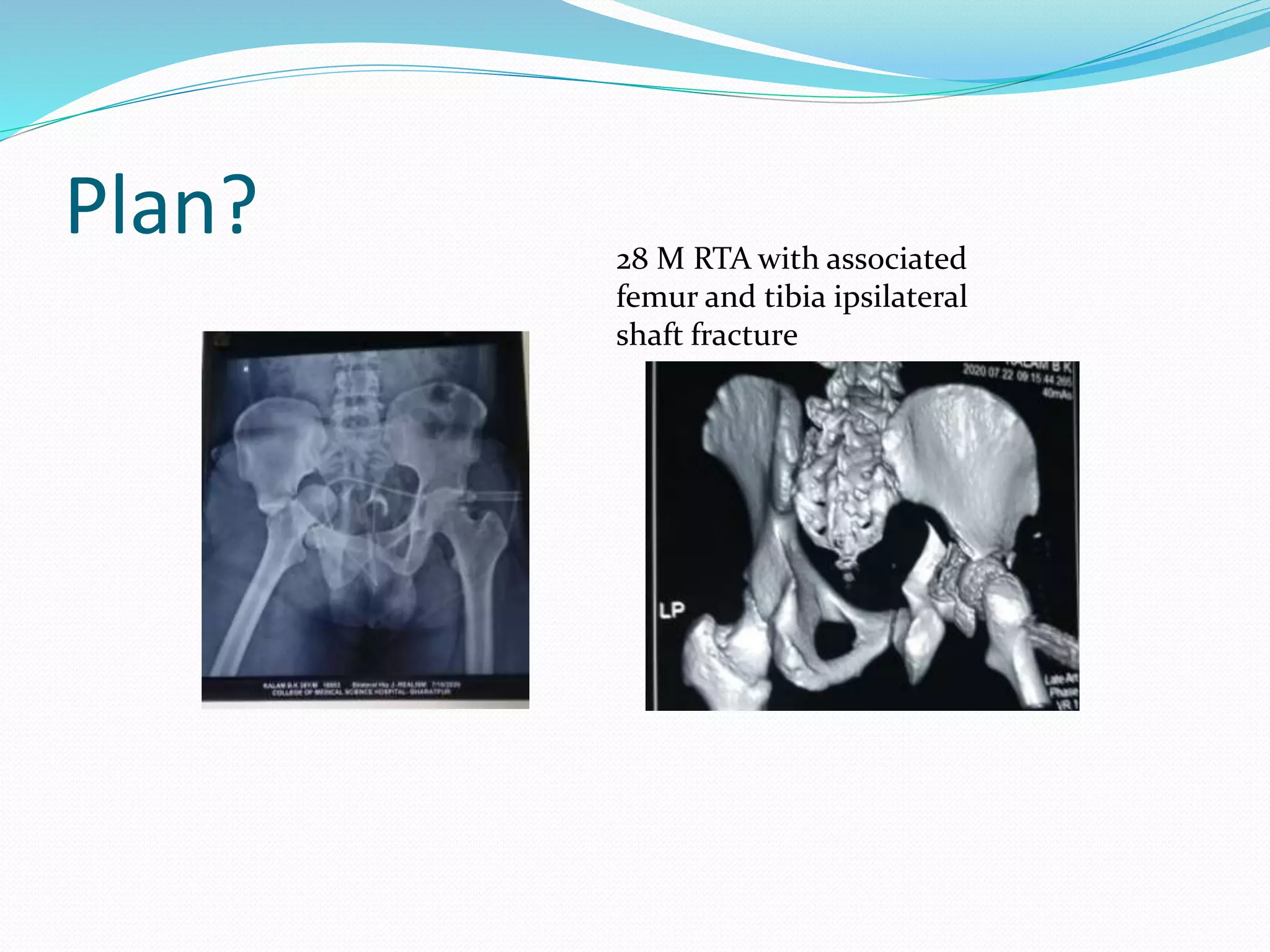 Approach to acetabulum fracture zoom 2020 | PPTX