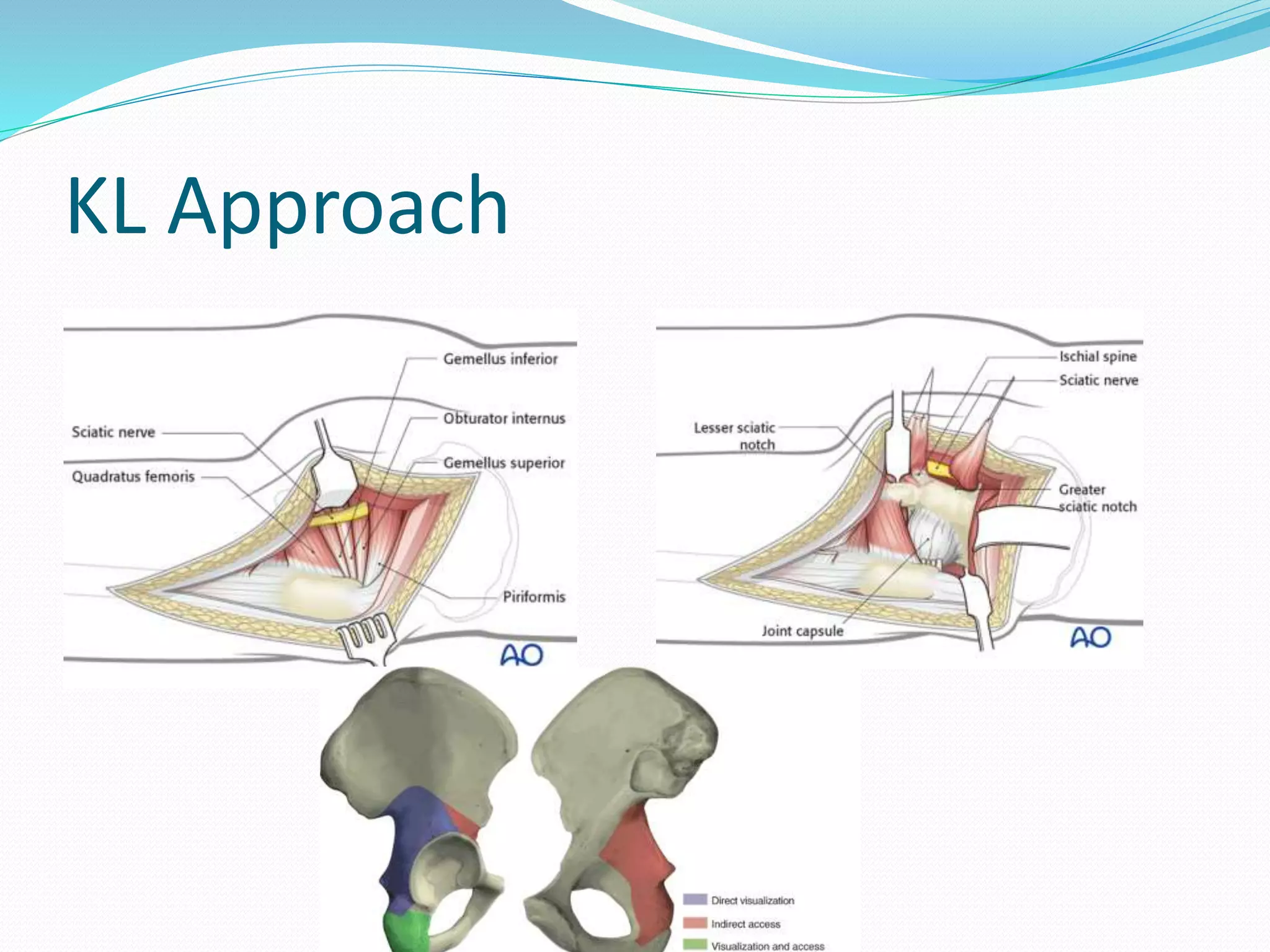 Approach to acetabulum fracture zoom 2020 | PPTX