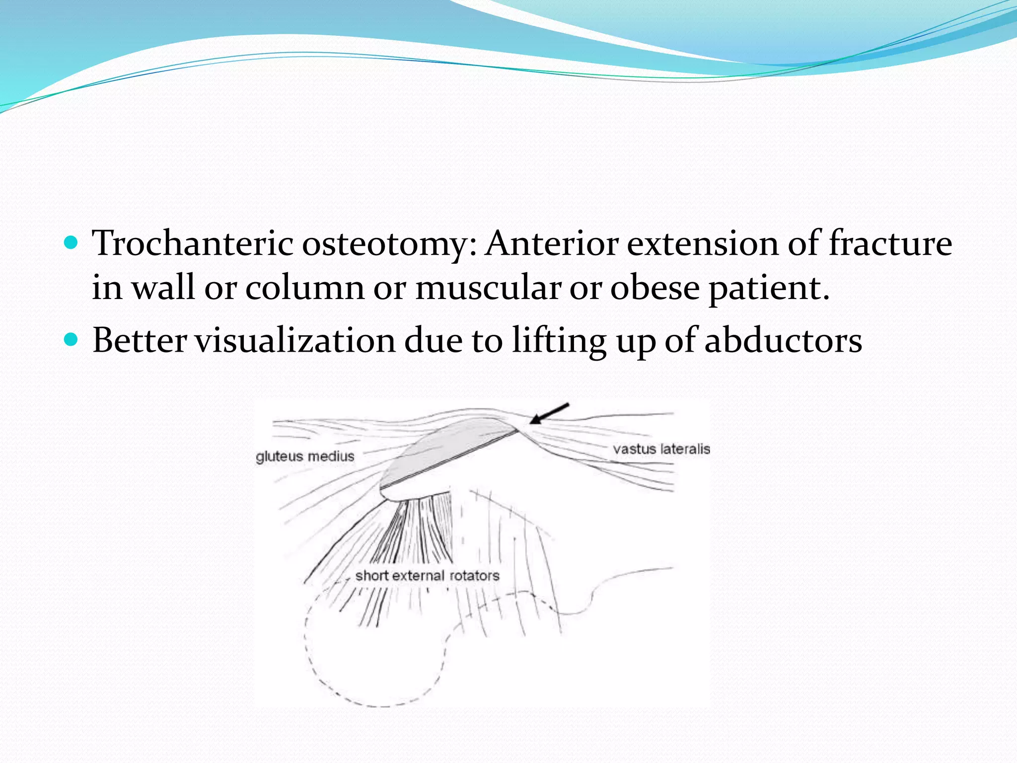 Approach to acetabulum fracture zoom 2020 | PPTX