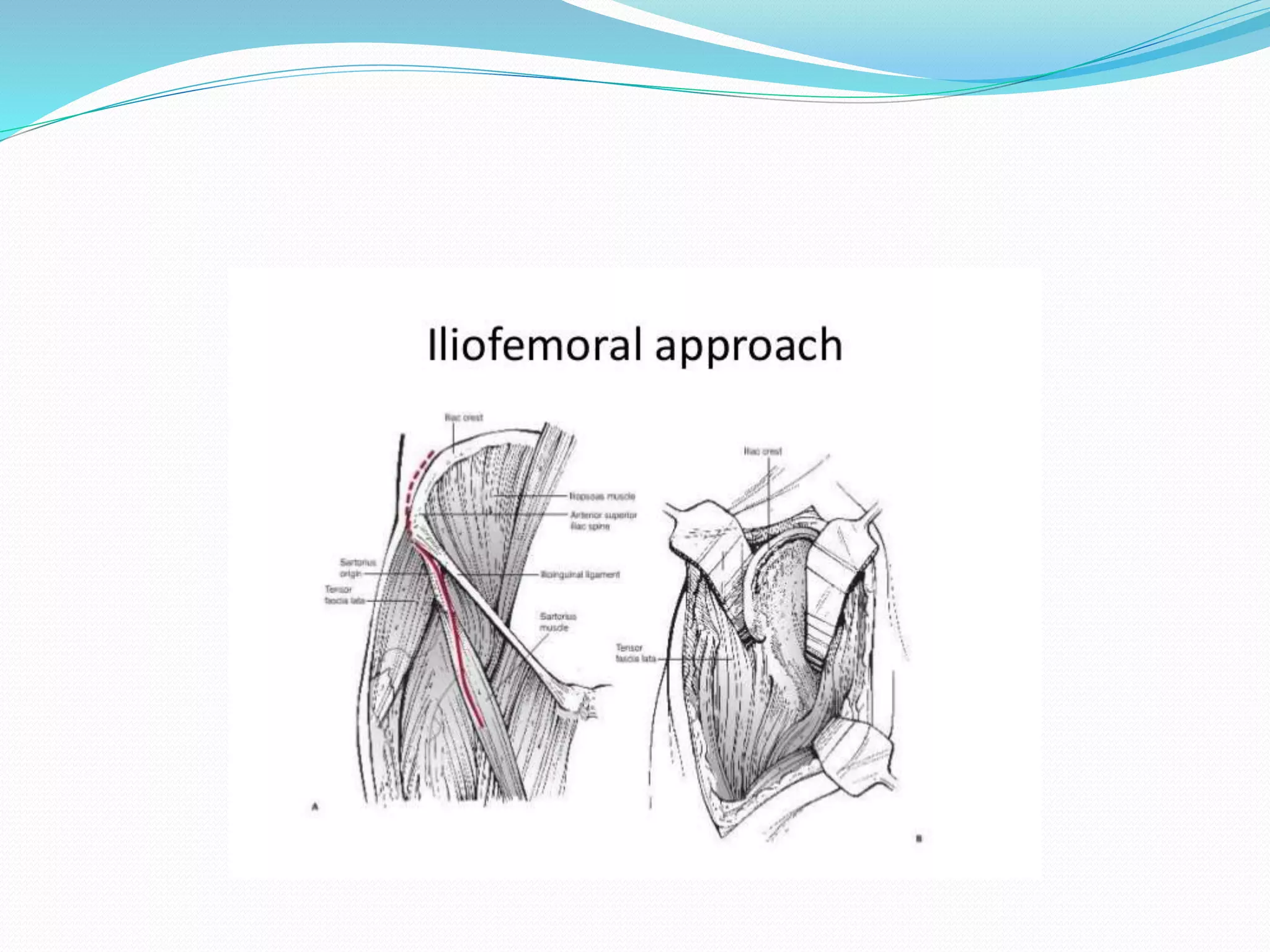 Approach to acetabulum fracture zoom 2020 | PPTX