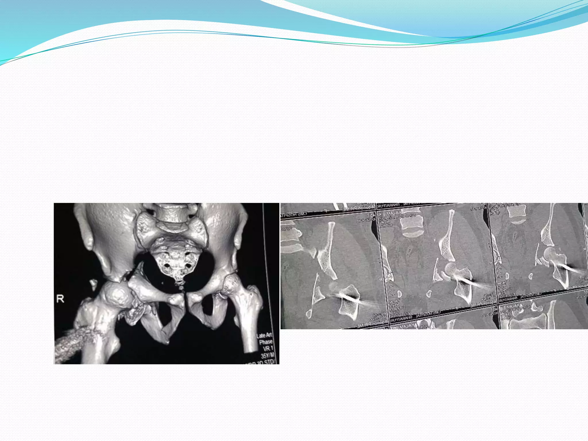 Approach to acetabulum fracture zoom 2020 | PPT