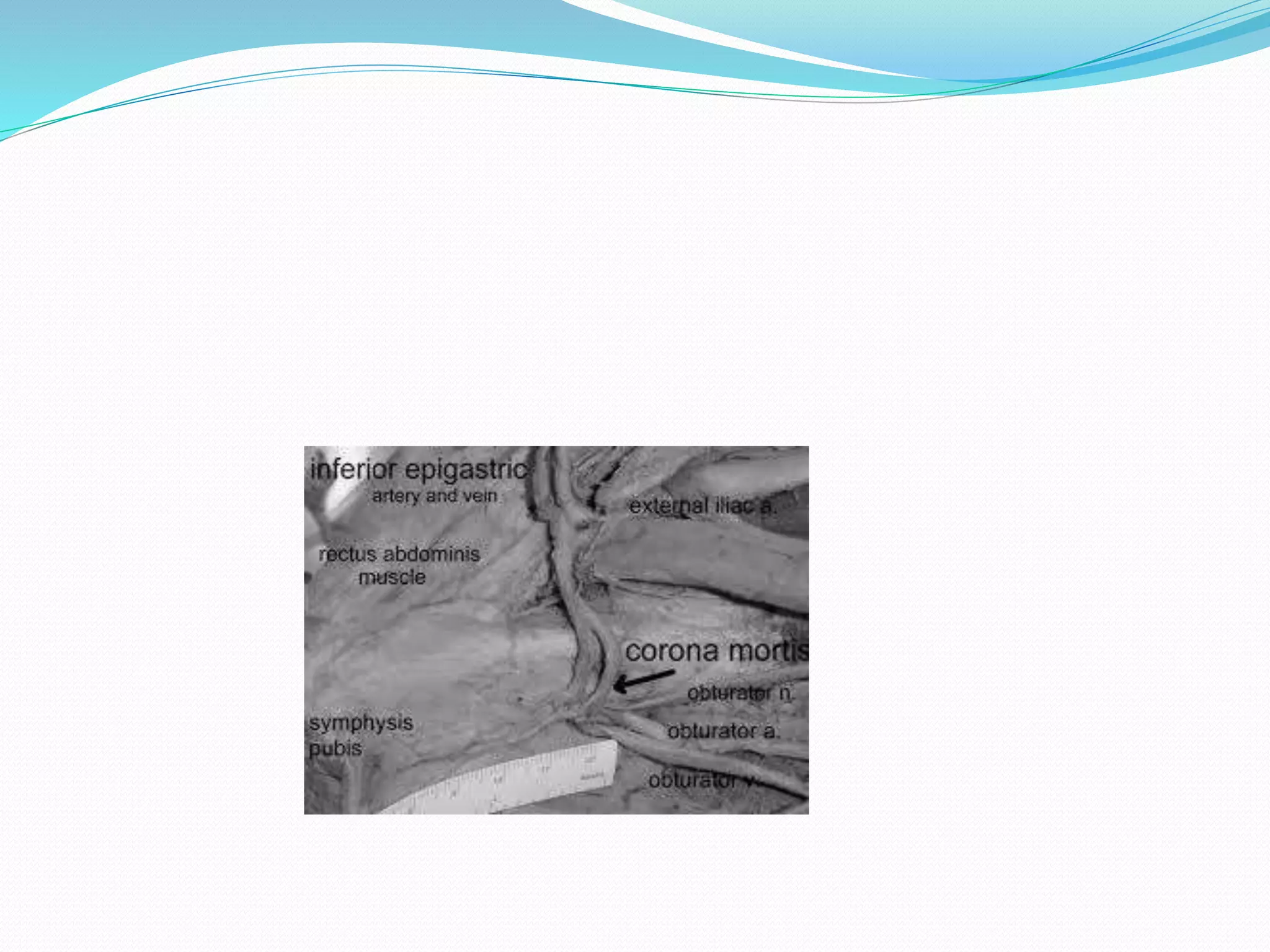 Approach to acetabulum fracture zoom 2020 | PPTX