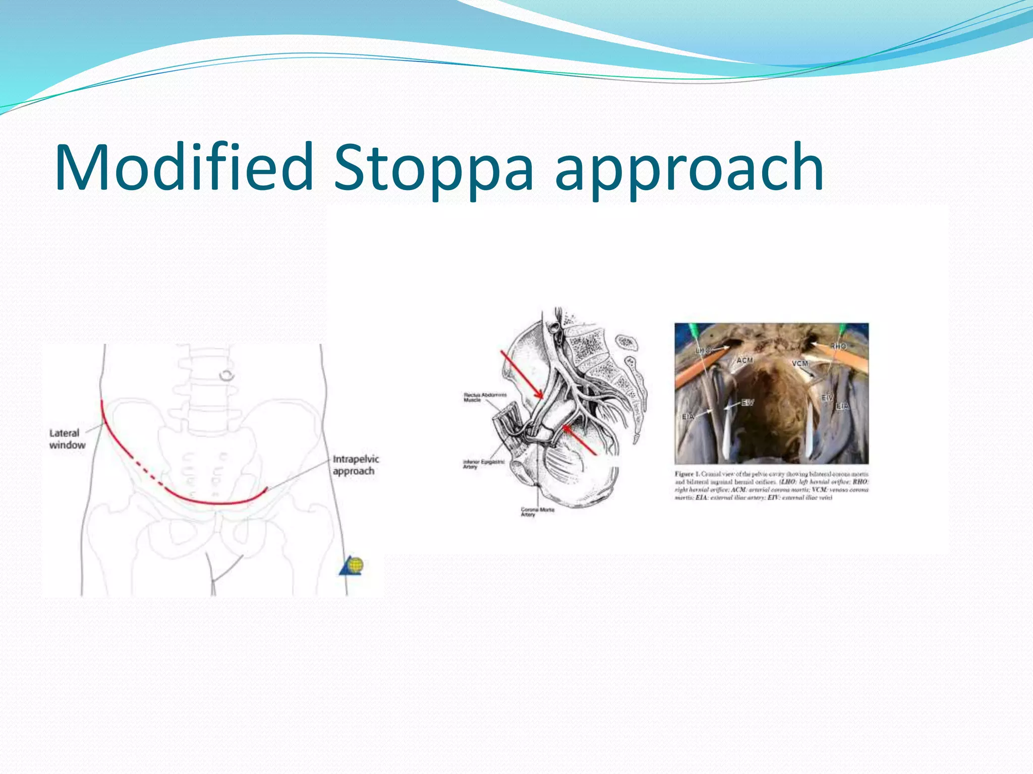 Approach to acetabulum fracture zoom 2020 | PPTX