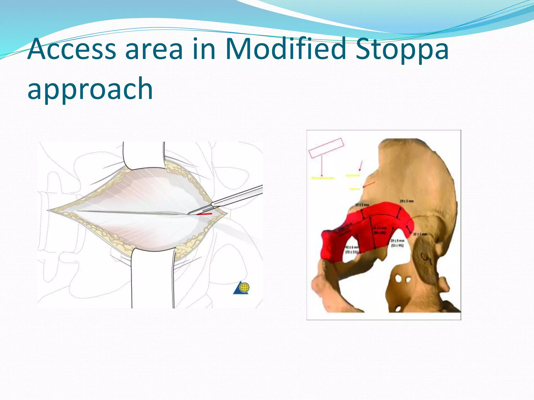 Approach to acetabulum fracture zoom 2020 | PPTX
